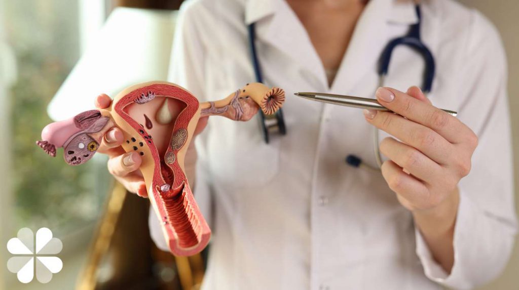 Manejo y Entendimiento de los Miomas Uterinos: Guía Completa